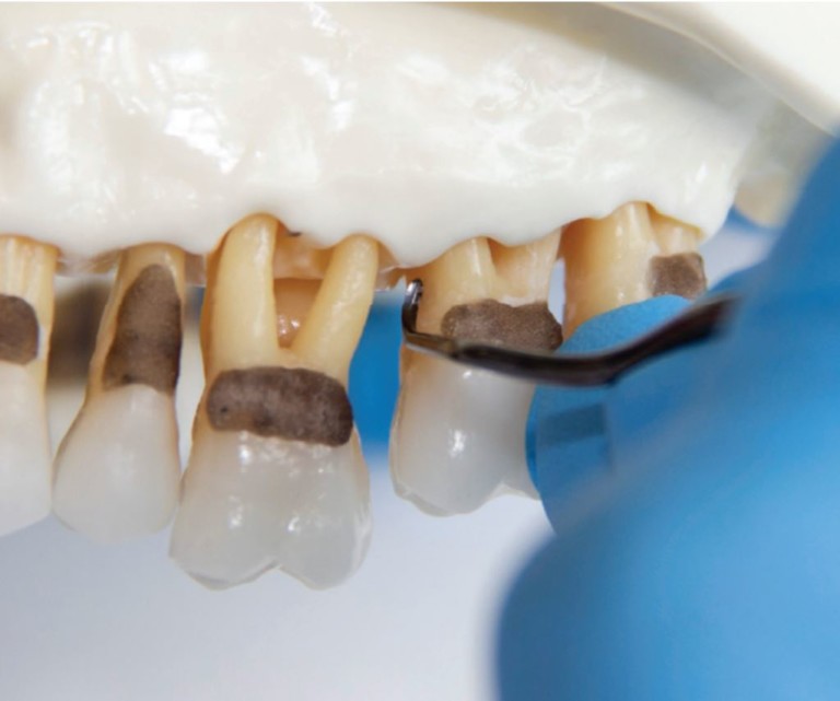 Effective instrumentation with LM Dual Gracey™ curettes - LM-Dental