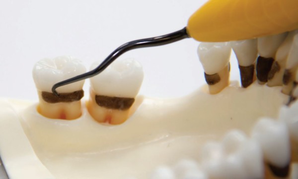 Effective instrumentation with LM Dual Gracey™ curettes - LM-Dental