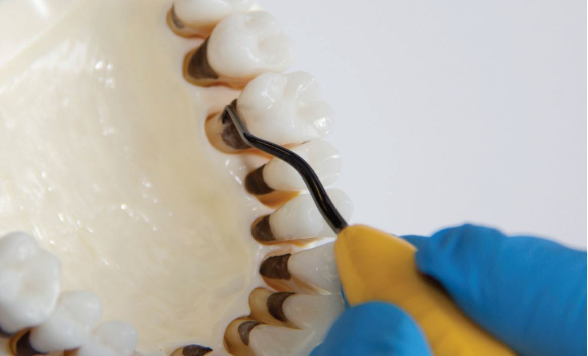 Effective instrumentation with LM Dual Gracey™ curettes - LM-Dental