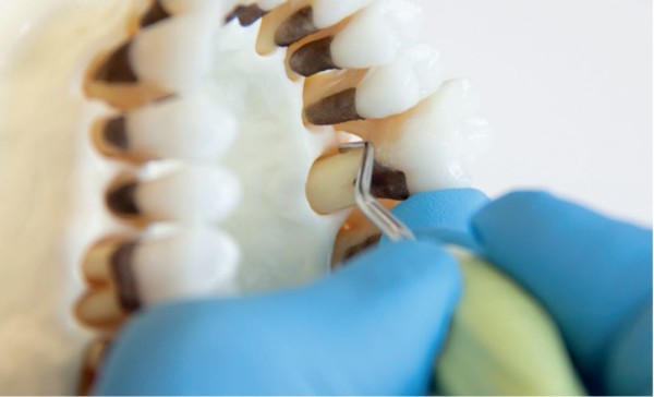 Effective instrumentation with LM™ Langer curettes - LM-Dental