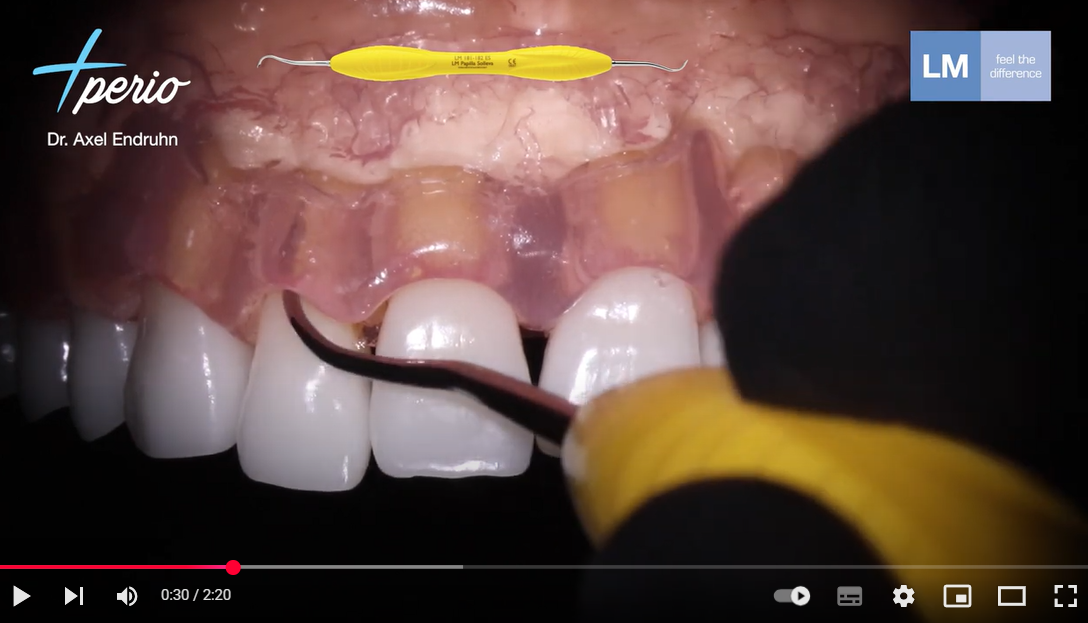How to use LM™ Papilla Solleva - LM-Dental