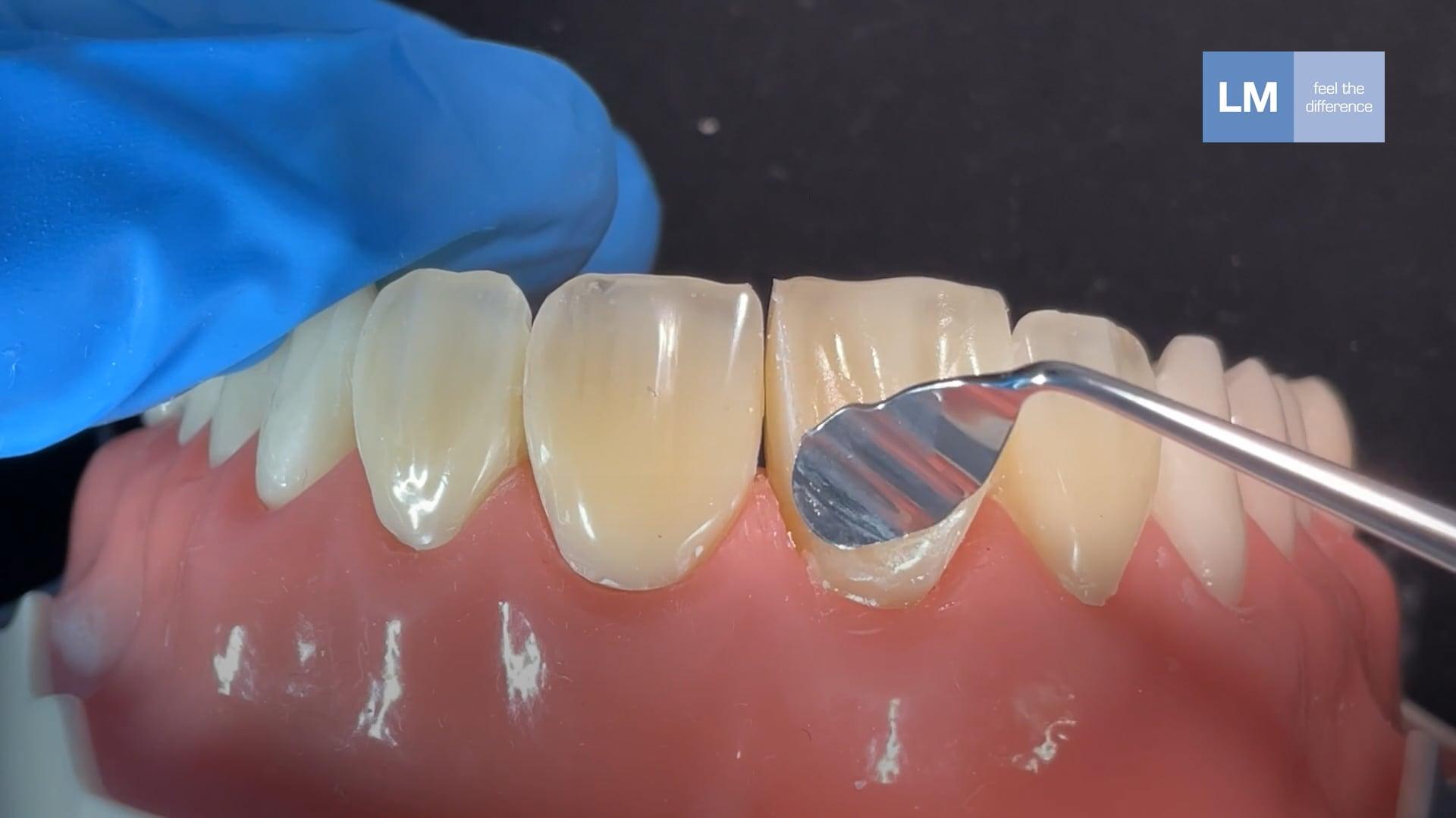 Two Shades Dentin + Enamel: case with LM-Arte™ Replica Anterior by Dr ...